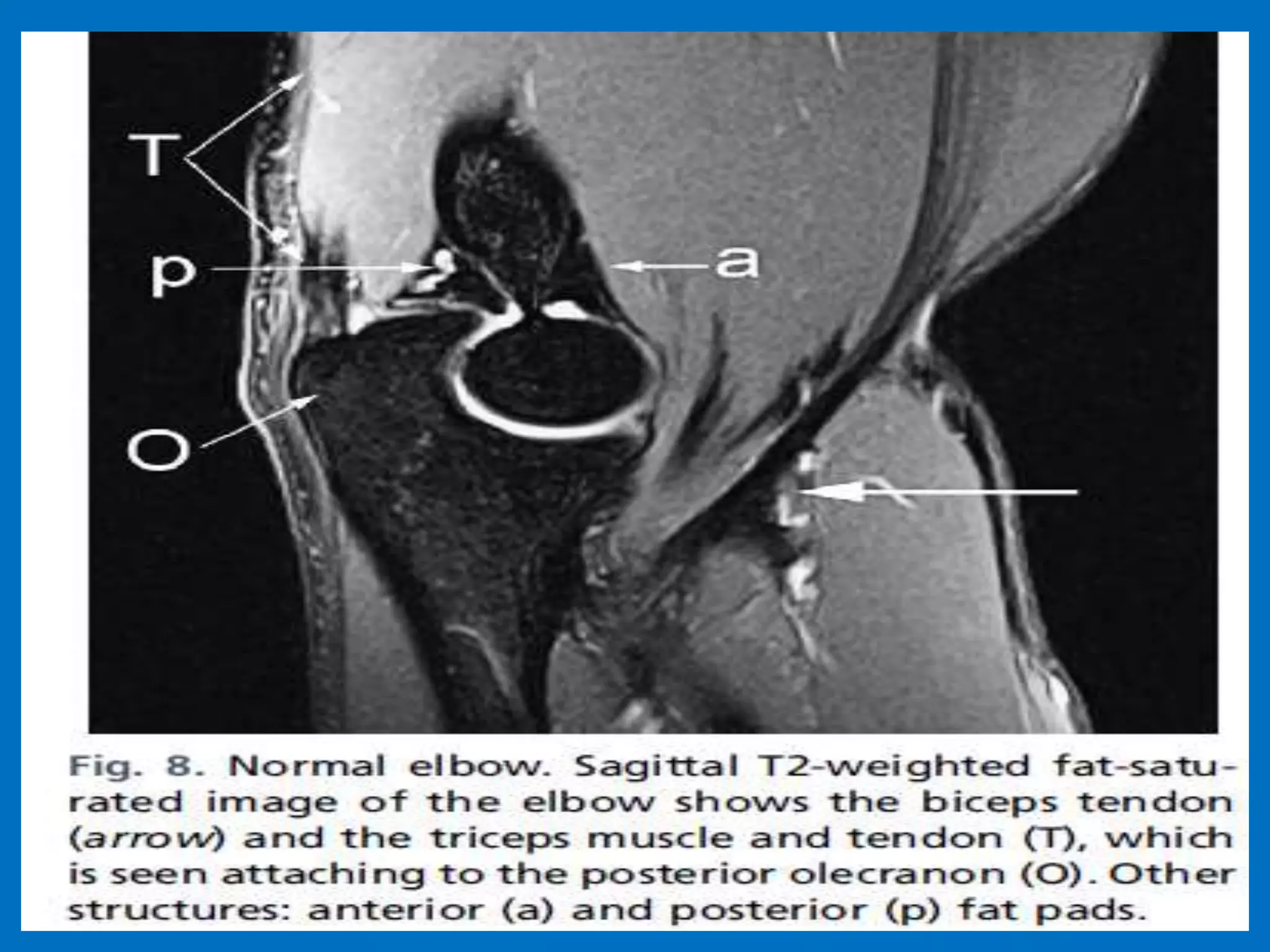Presentation1.pptx mri of elbow joint | PPTX