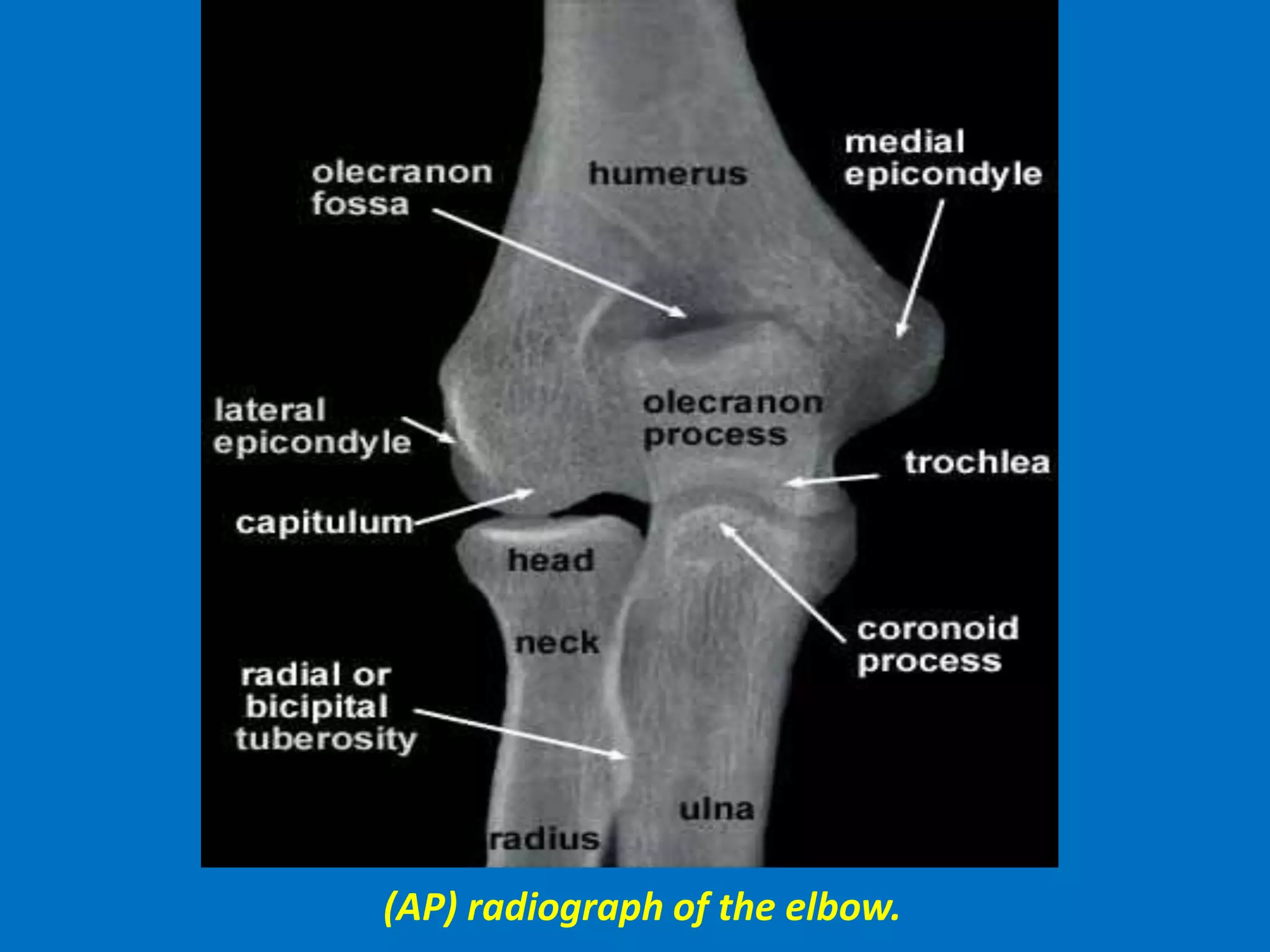 Presentation1.pptx mri of elbow joint | PPTX