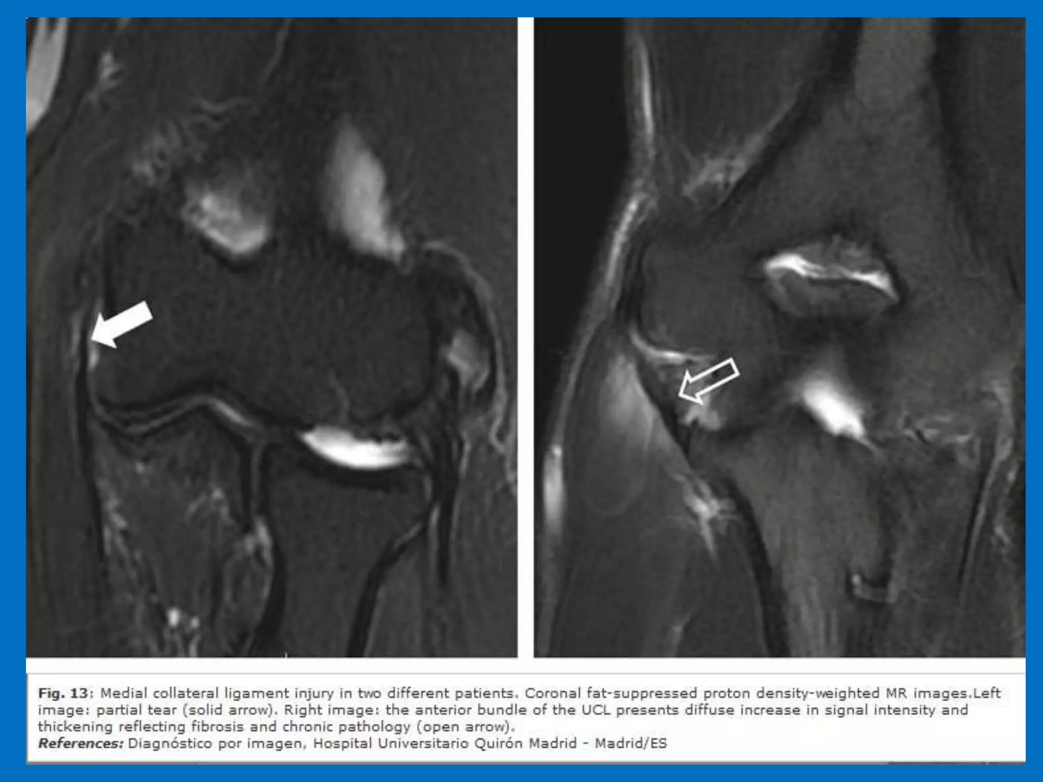 Presentation1.pptx mri of elbow joint | PPTX