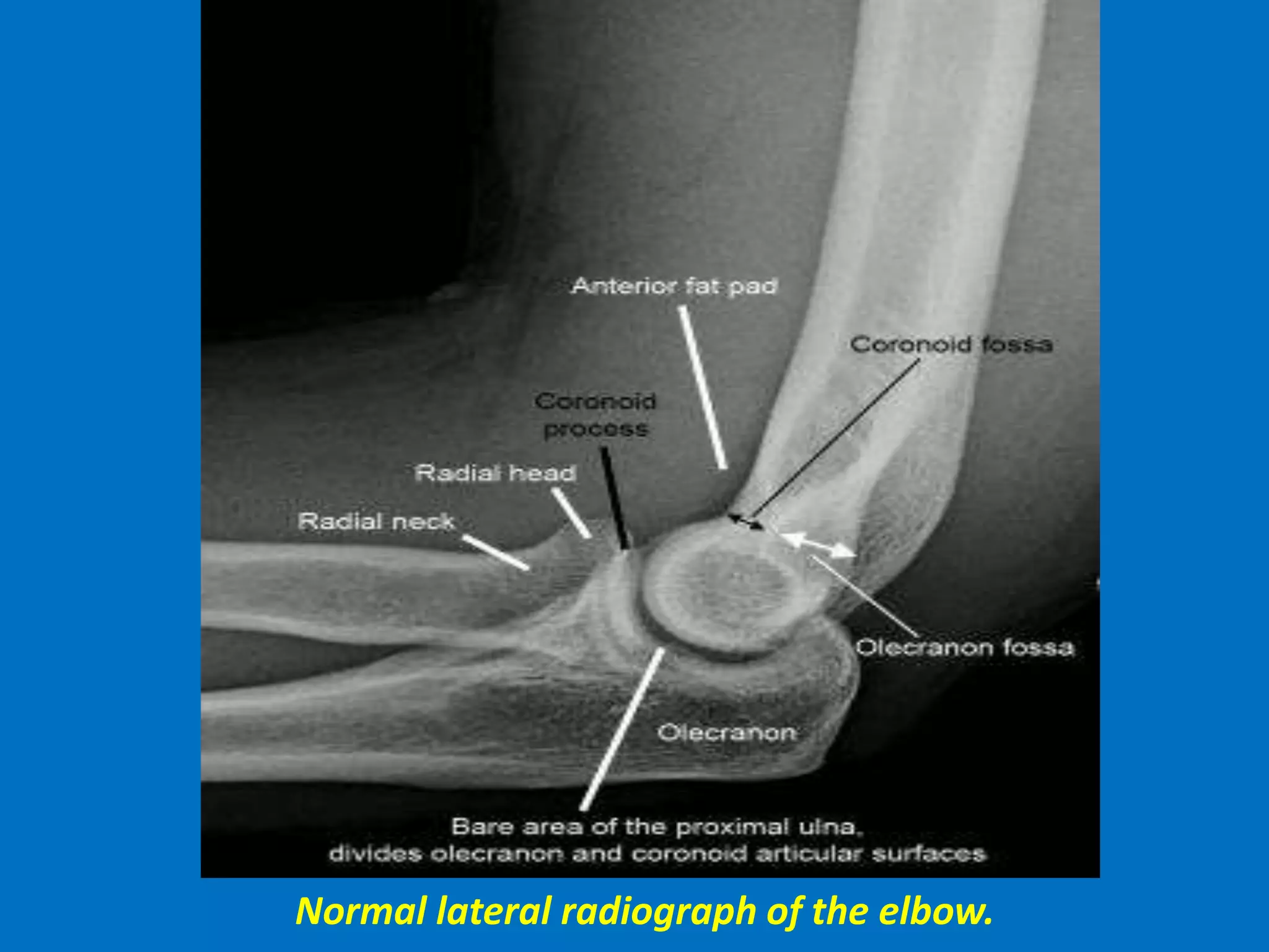 Presentation1.pptx mri of elbow joint | PPTX
