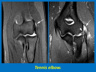 Tennis Elbow Mri