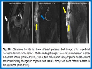 Olecranon Bursitis Mri