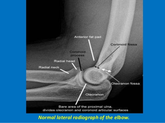 Presentation1.pptx mri of elbow joint