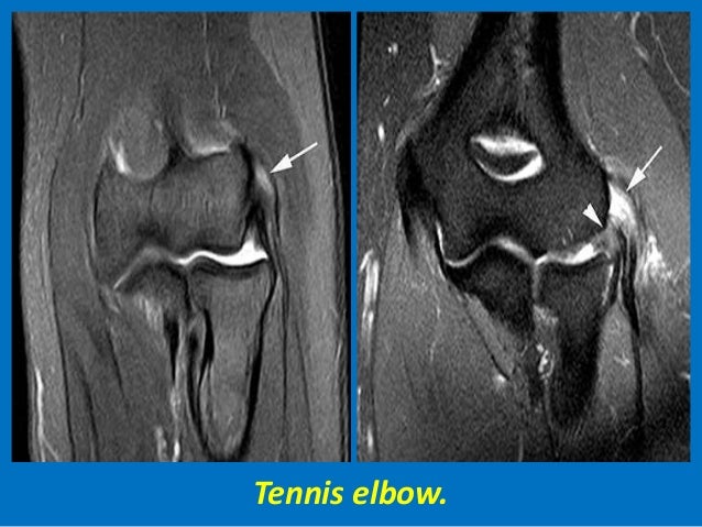 Presentation1.pptx mri of elbow joint