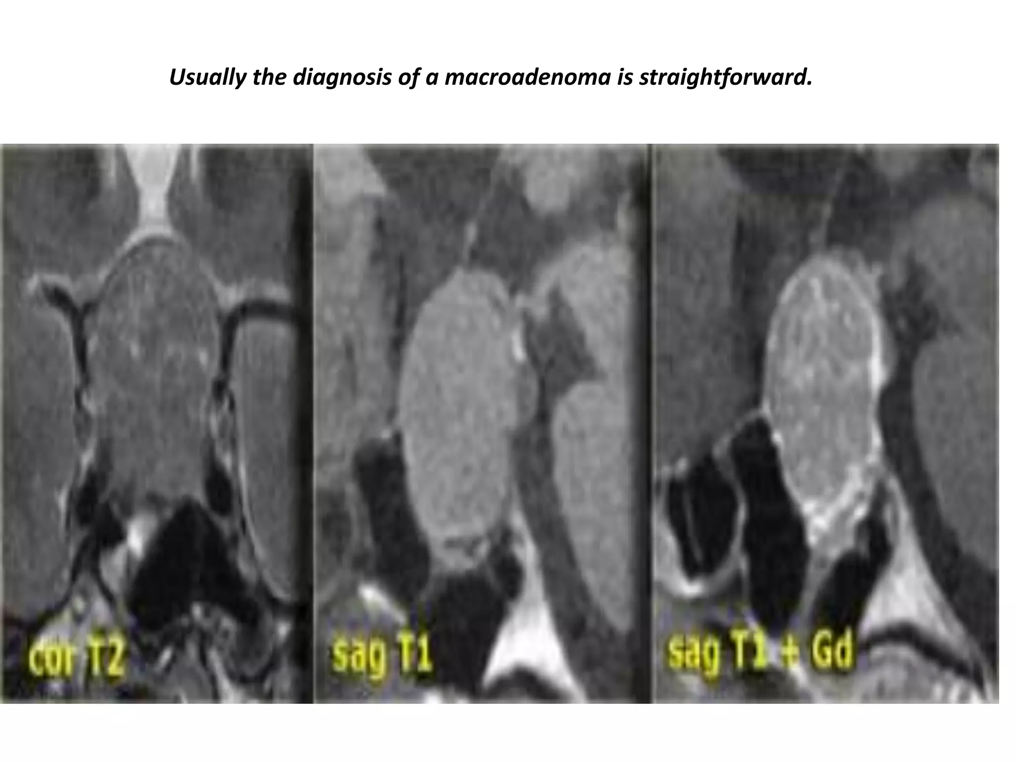 Presentation1.pptx sellar and para sellar masses