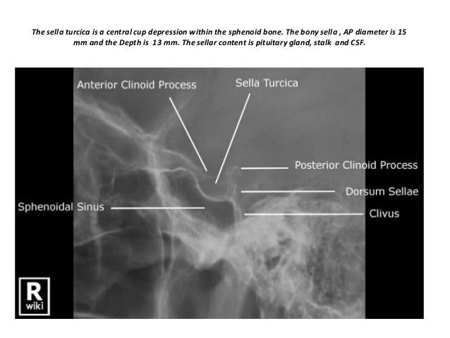 Presentation1.pptx sellar and para sellar masses