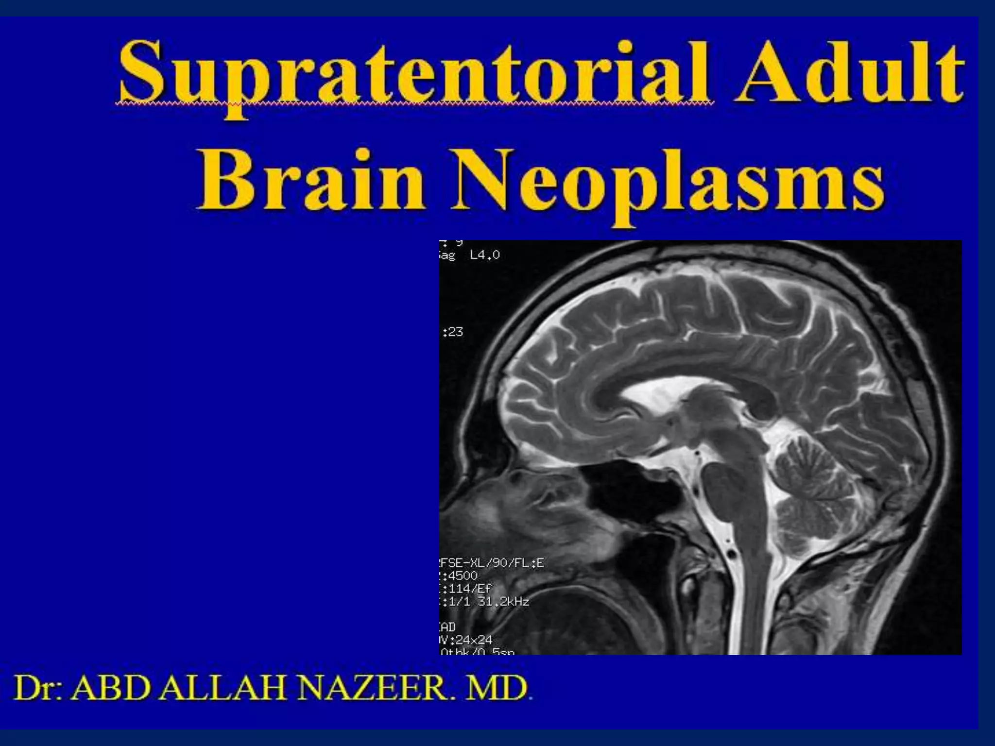 Presentation1.pptx, supratentorial brain tumour | PPTX