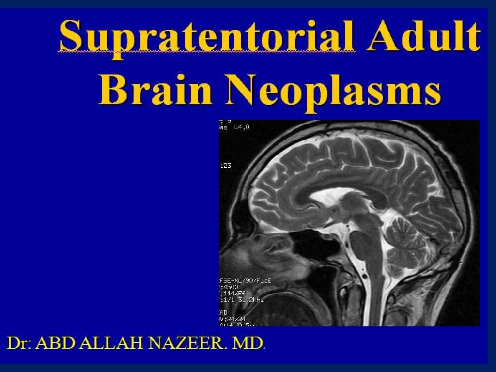 Presentation1.pptx, supratentorial brain tumour