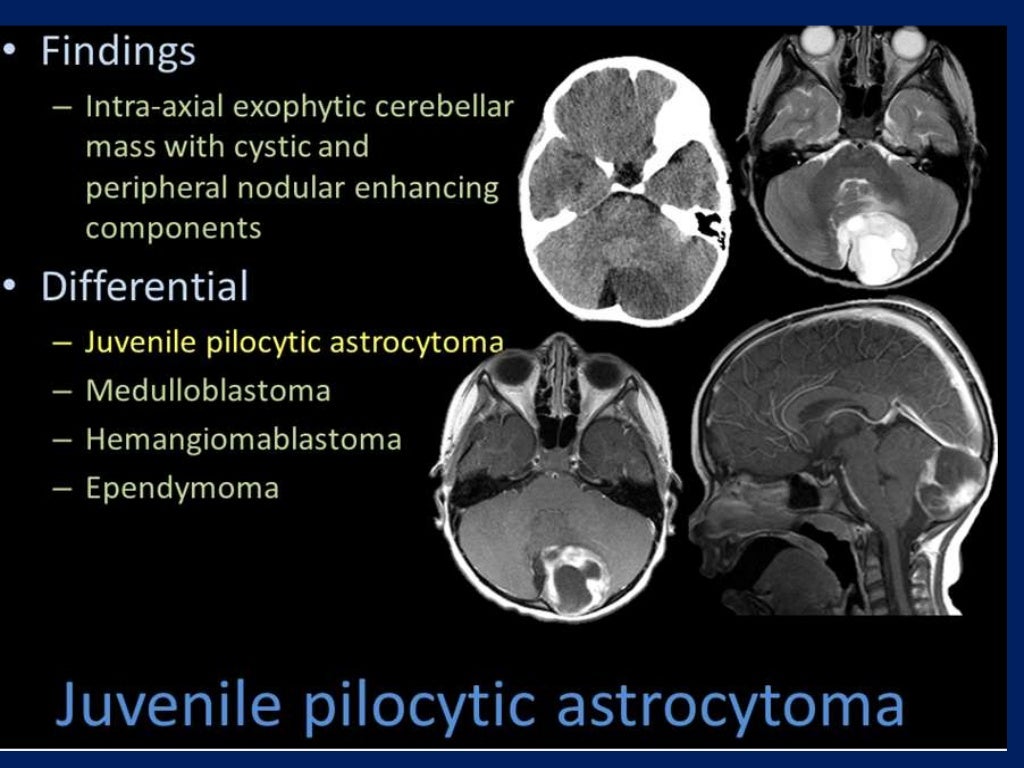 Presentation1.pptx, supratentorial brain tumour