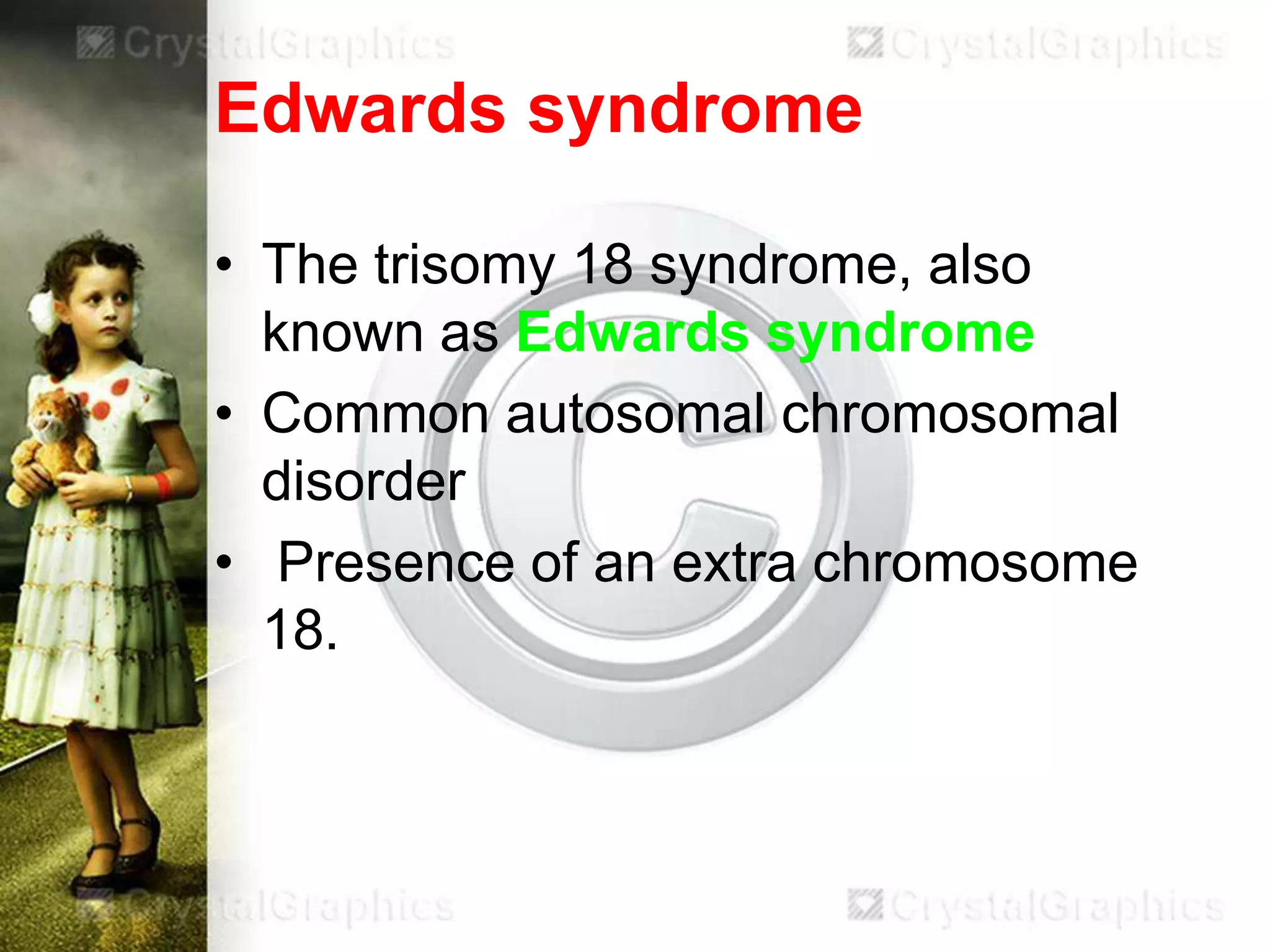 EDWARD SYNDROME | PPTX