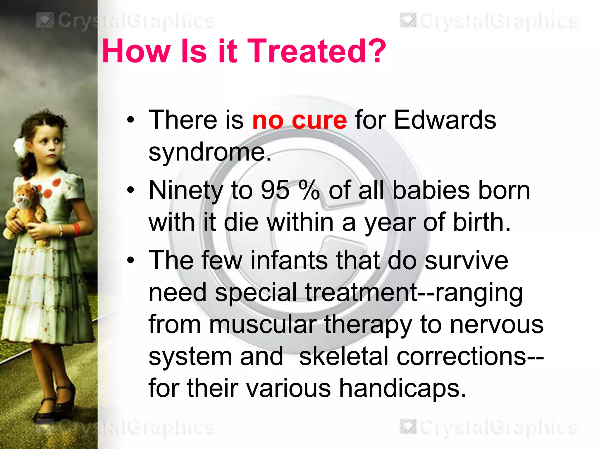 EDWARD SYNDROME | PPTX