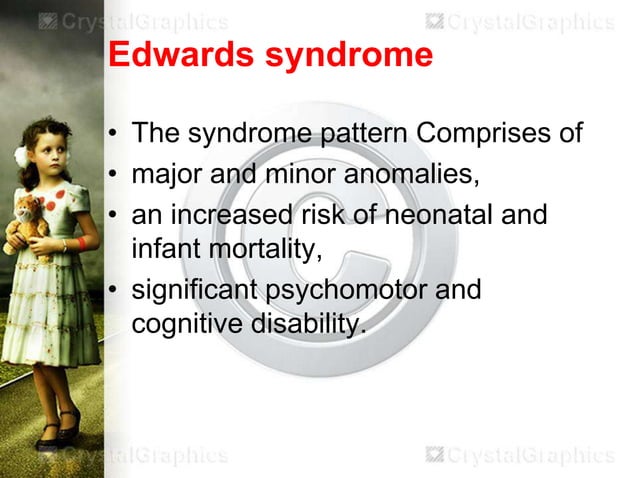 EDWARD SYNDROME | PPTX