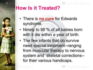 Edwards Syndrome Symptoms