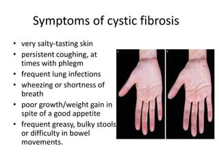 Cystic Fibrosis Presentation | PPTX