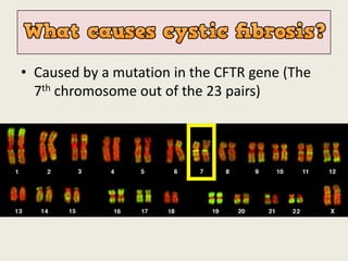 Cystic Fibrosis Presentation | PPTX