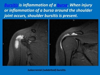 Mri Shoulder Bursitis