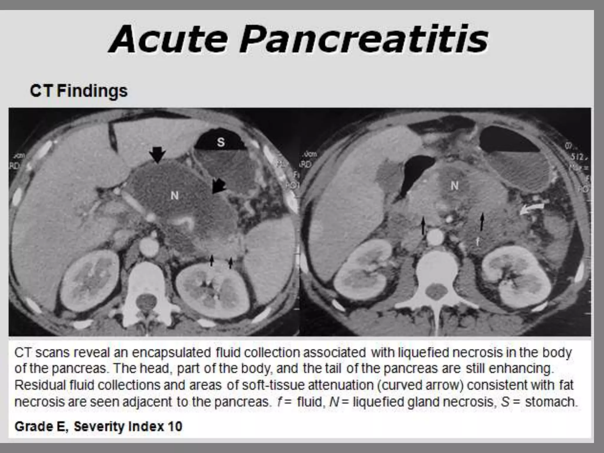 Presentation1.pptx pancreatic disease. | PPT