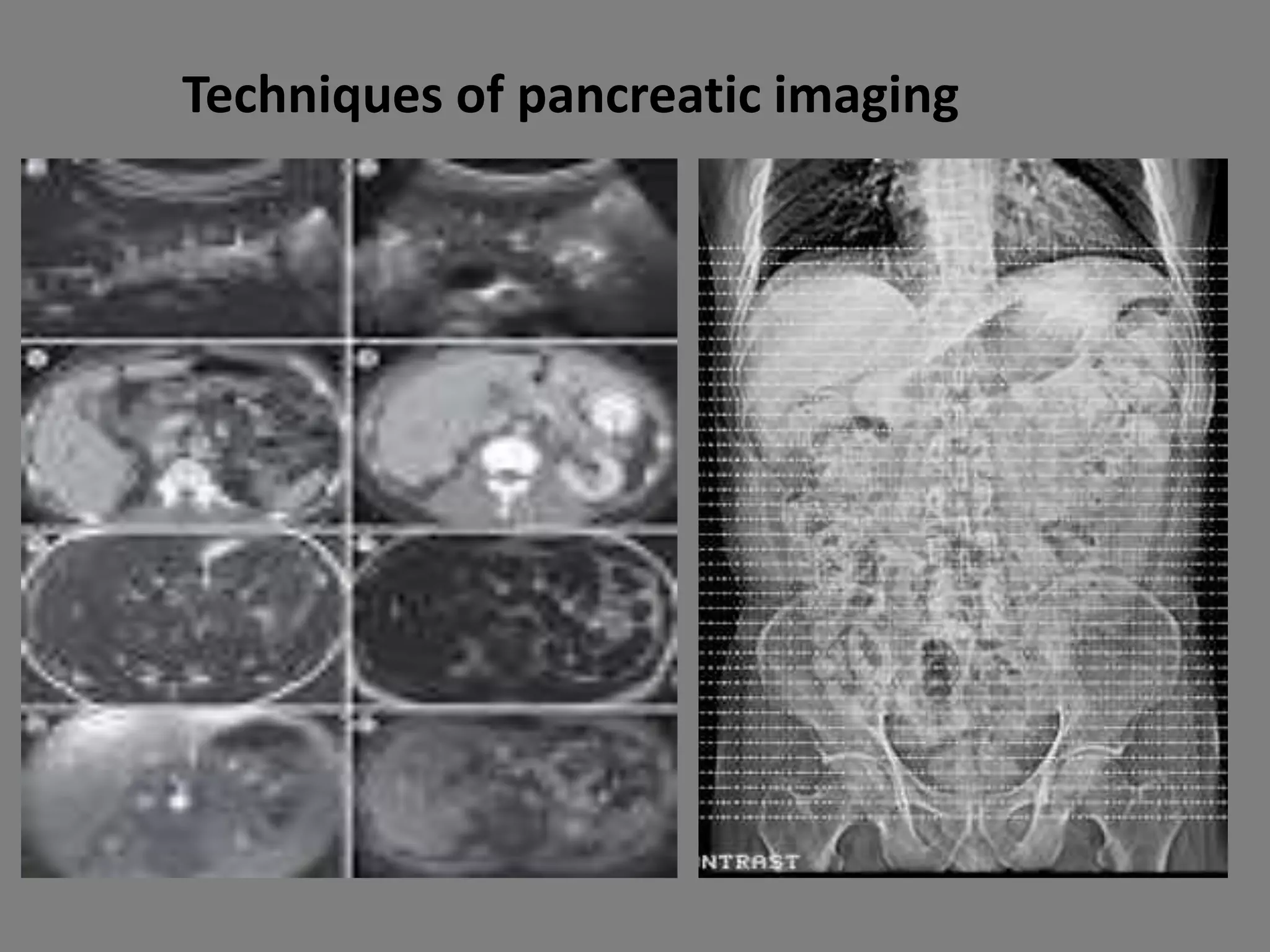 Presentation1.pptx pancreatic disease. | PPT | Free Download