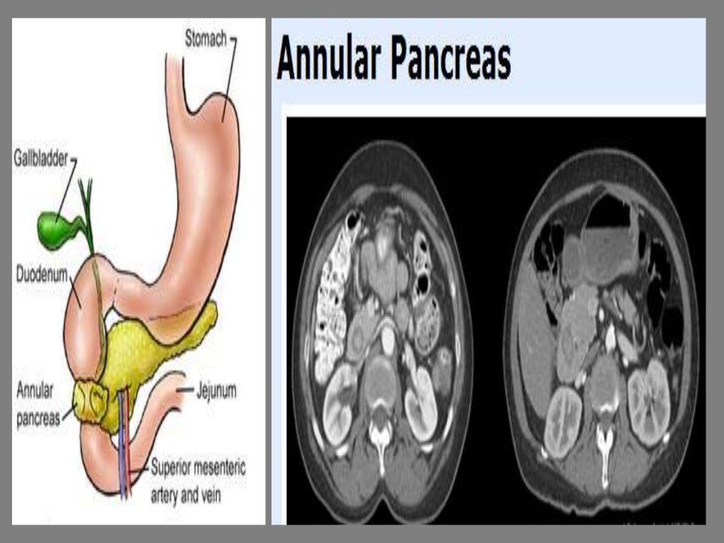 Presentation1.pptx pancreatic disease.