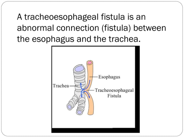 Acquired Tracheo-esophageal fistula | PPT