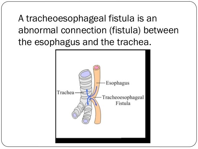 Acquired Tracheo-esophageal fistula