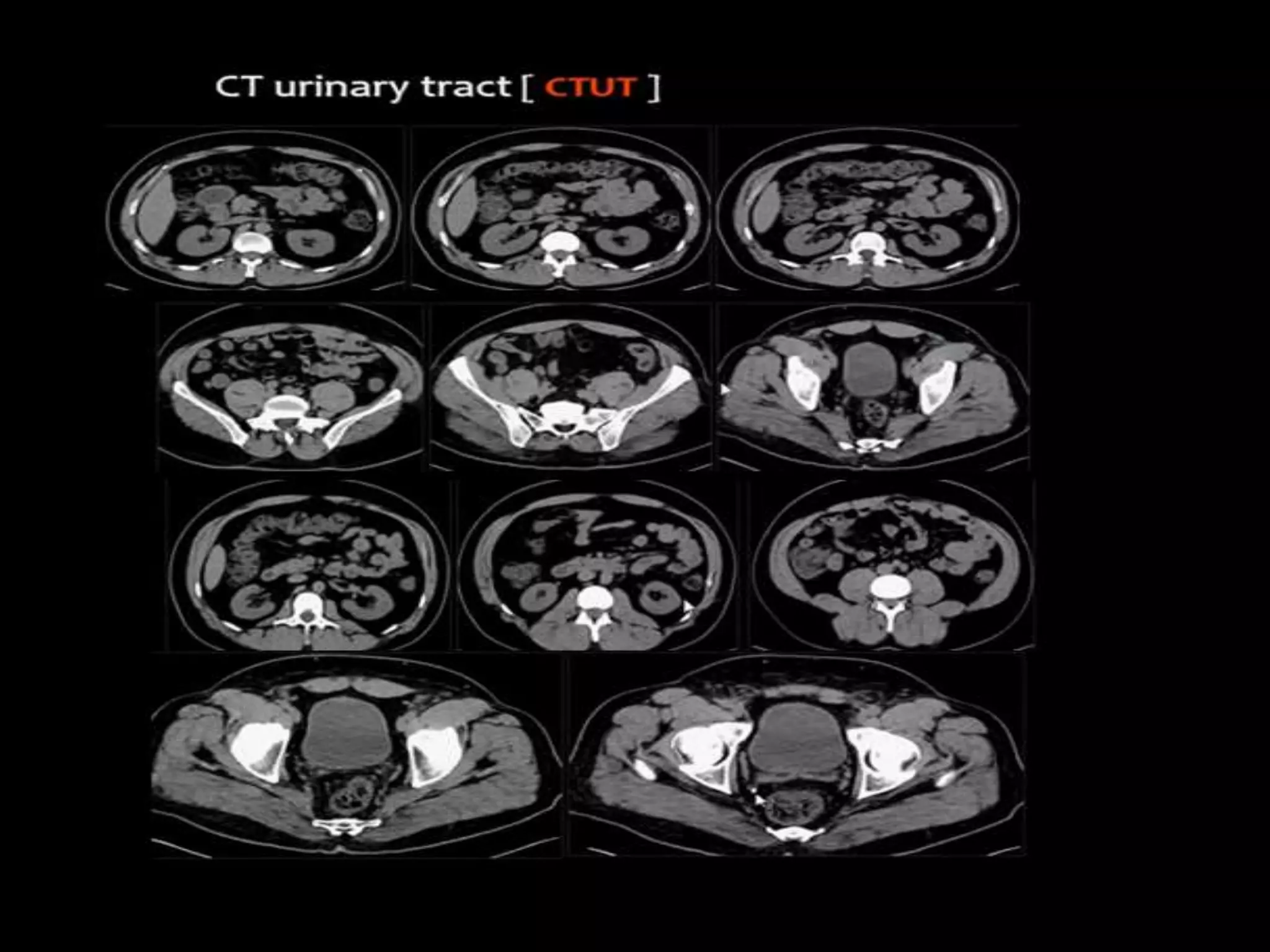 Presentation1.pptx, imaging of the urinary system. | PPTX