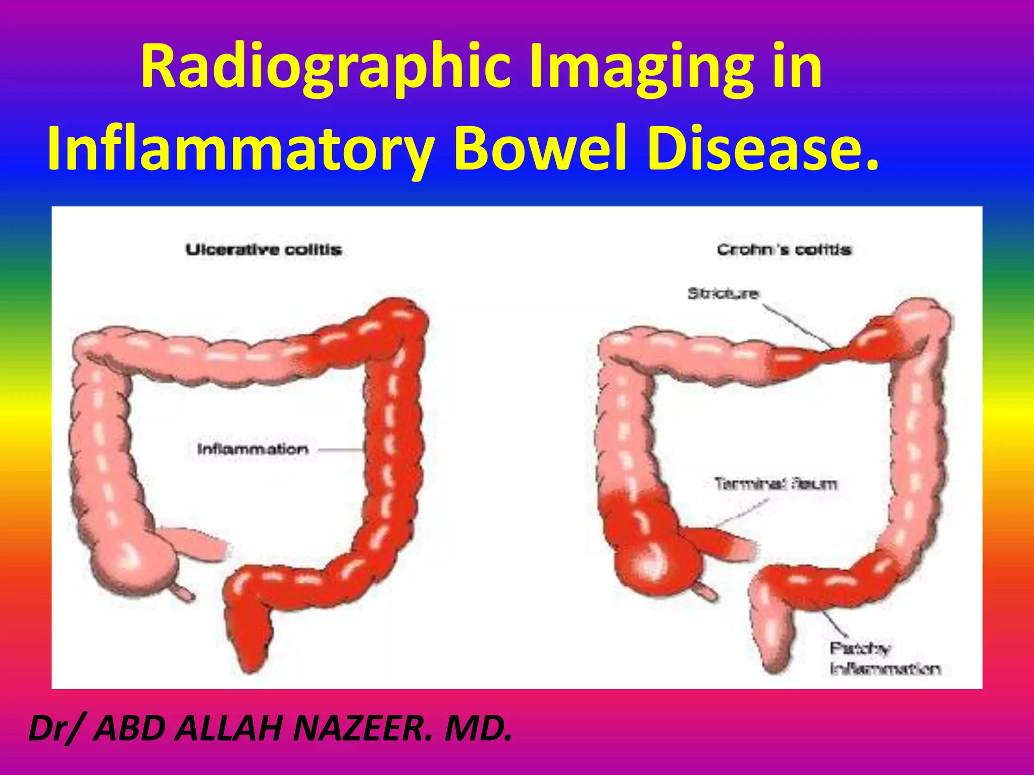 Presentation1.pptx. inflammatory bowel disease. | PPTX