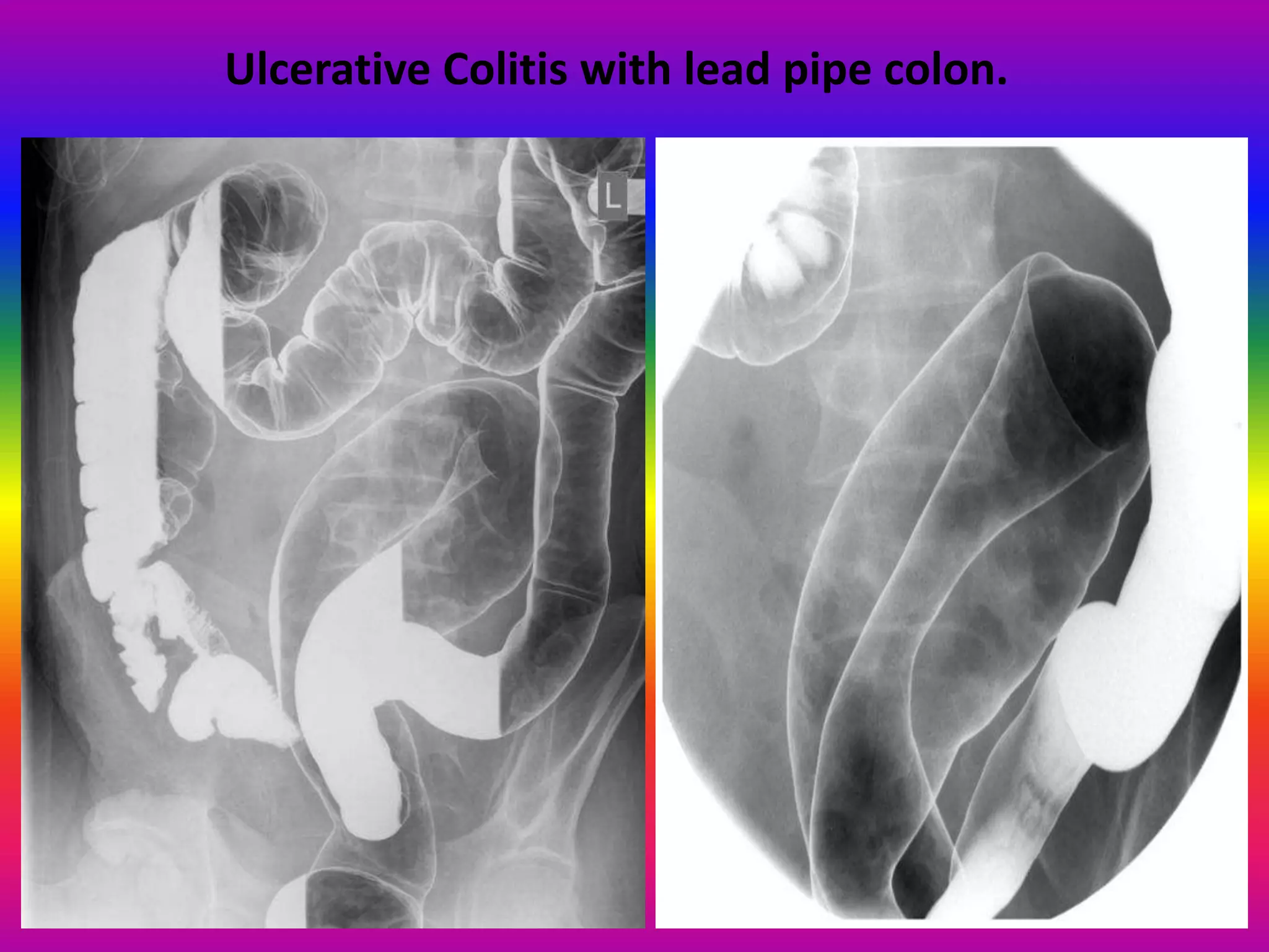 Presentation1.pptx. inflammatory bowel disease. | PPTX