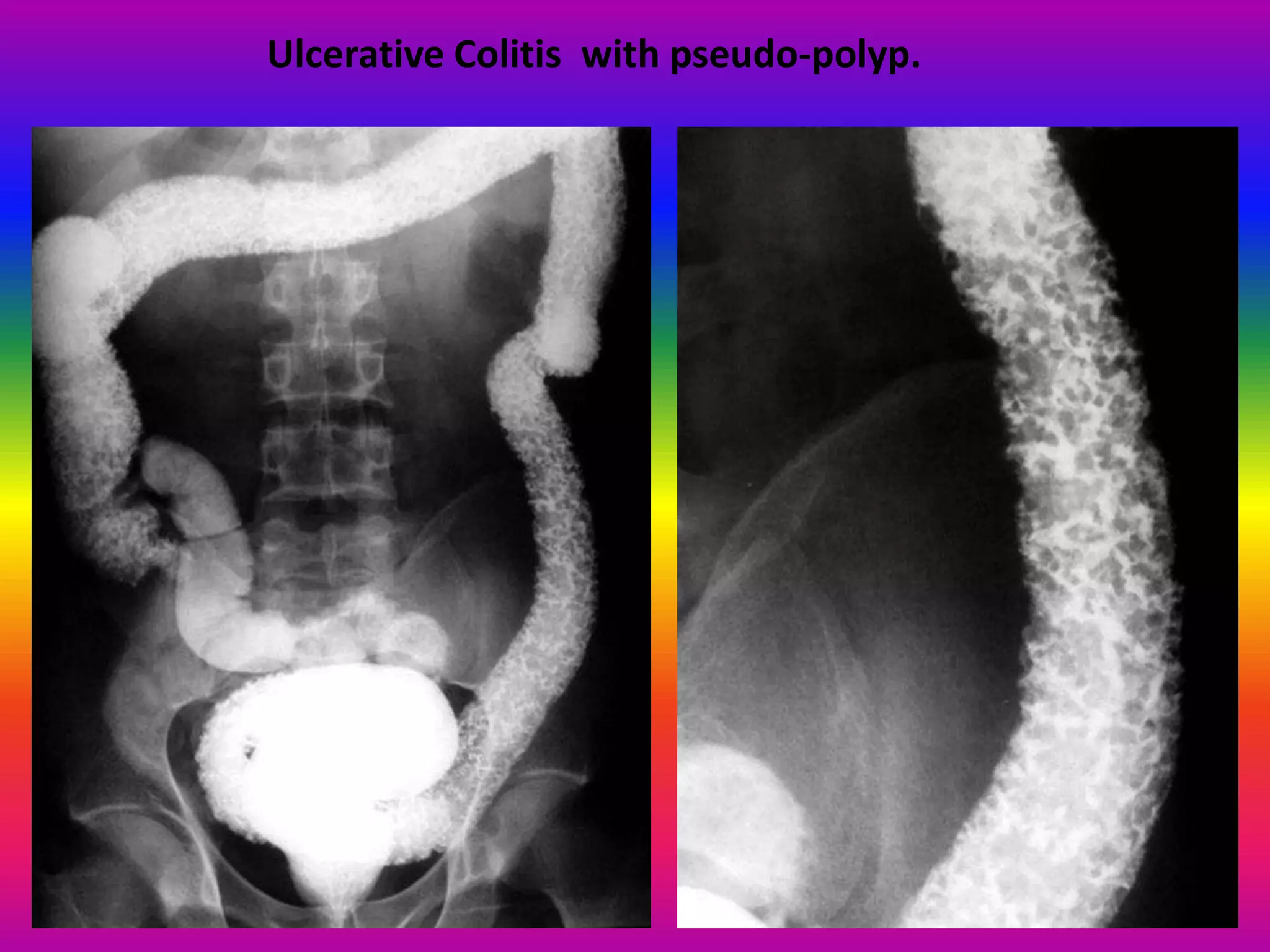 Presentation1.pptx. inflammatory bowel disease. | PPTX