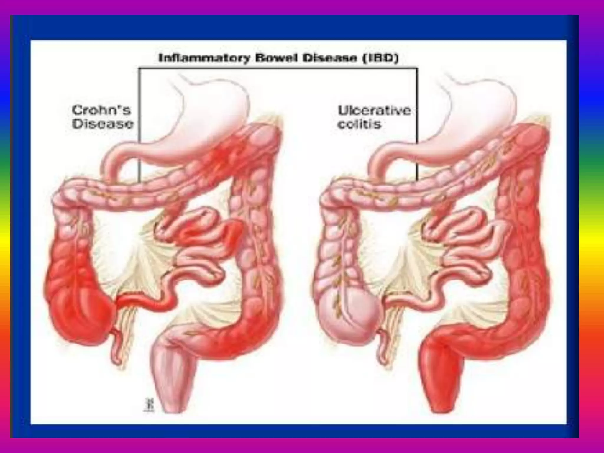 Presentation1.pptx. inflammatory bowel disease. | PPTX