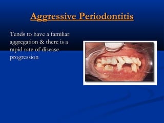 Aggressive Periodontitis | PPT