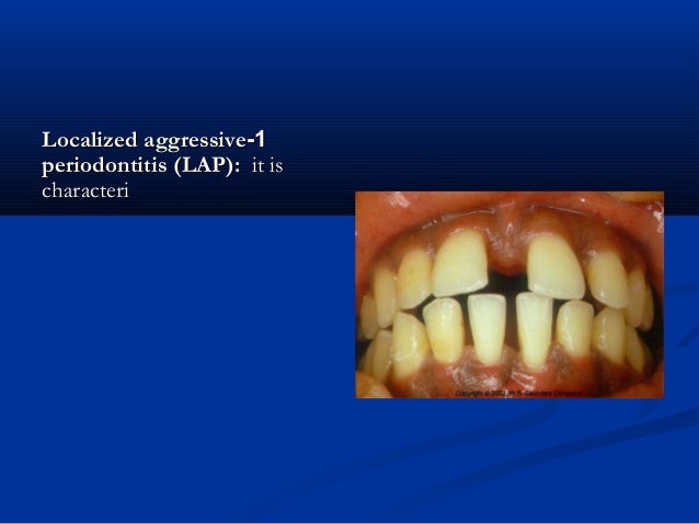 Aggressive Periodontitis