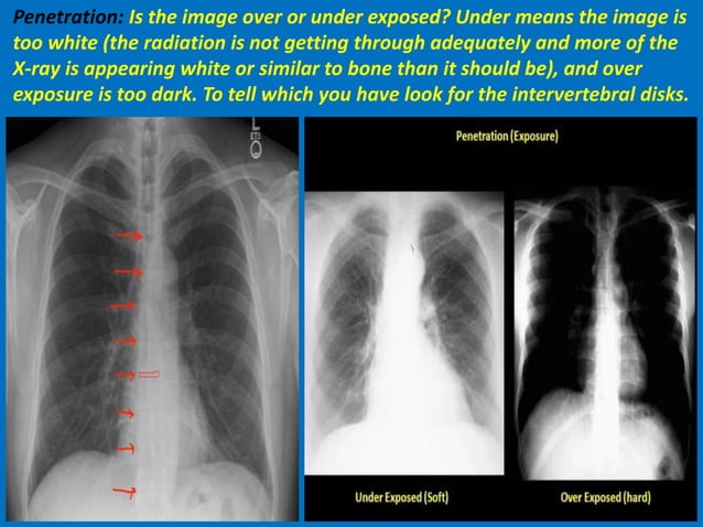Presentation1.pptx. interpretation of x ray chest. Presentation1.pptx. interpretation of x ray chest.