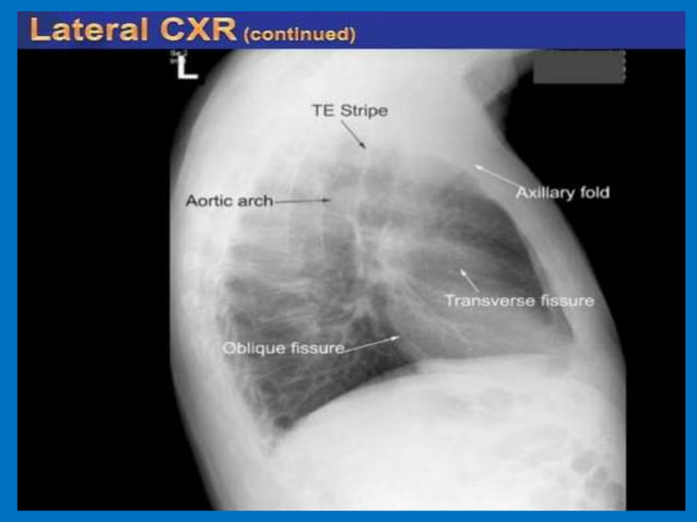 Presentation1.pptx. interpretation of x ray chest. Presentation1.pptx. interpretation of x ray chest.