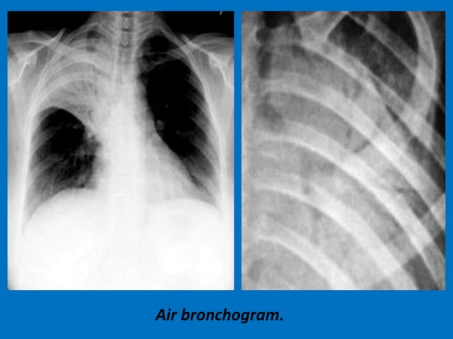 Presentation1.pptx. interpretation of x ray chest. Presentation1.pptx. interpretation of x ray chest.