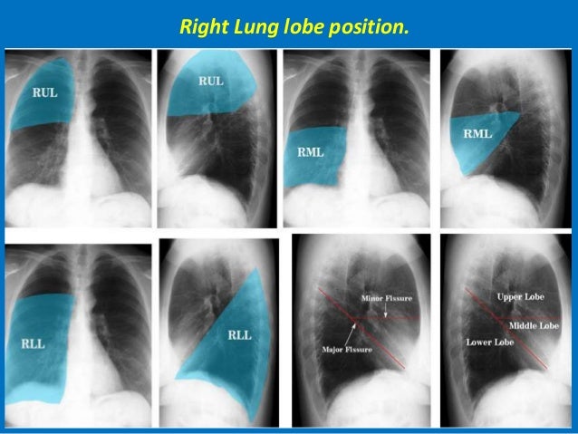 Presentation1.pptx. interpretation of x ray chest. Presentation1.pptx. interpretation of x ray chest.