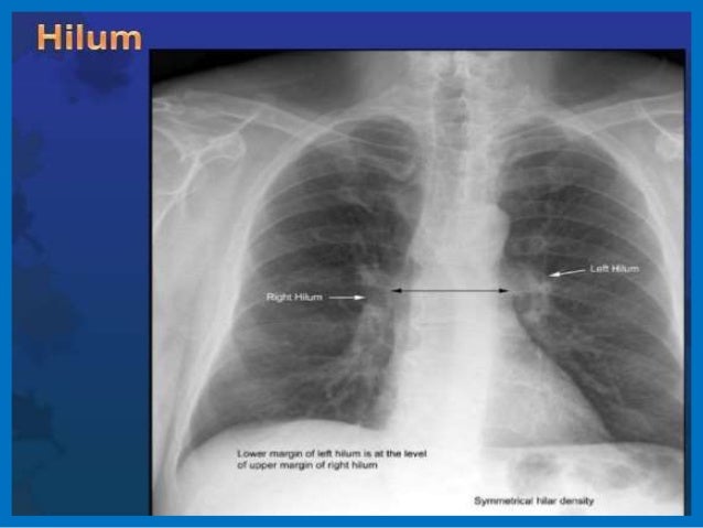 Presentation1.pptx. interpretation of x ray chest.
