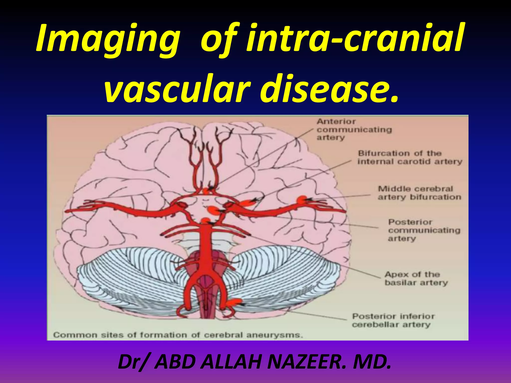 Presentation1.pptx, intra cranial vascular malformation. | PPTX
