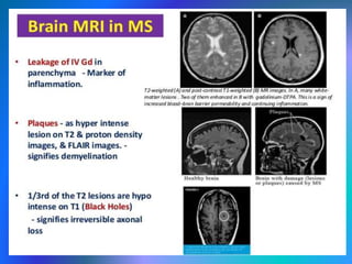 Multiple Sclerosis Mri