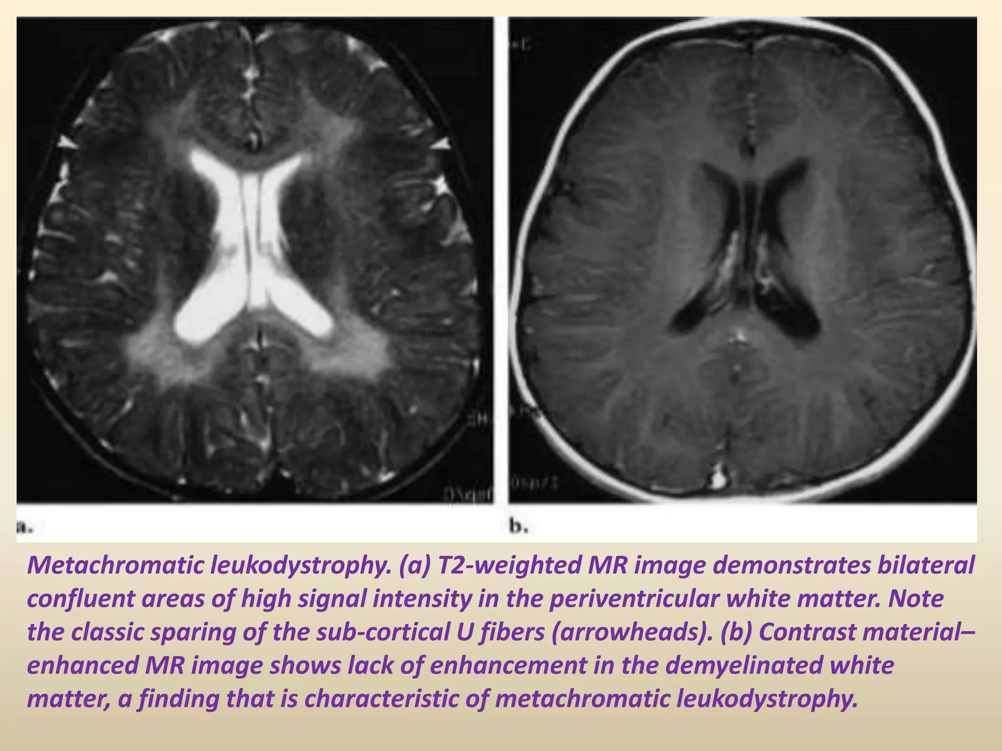 Presentation1.pptx white matter disorder in pediatric | PPTX