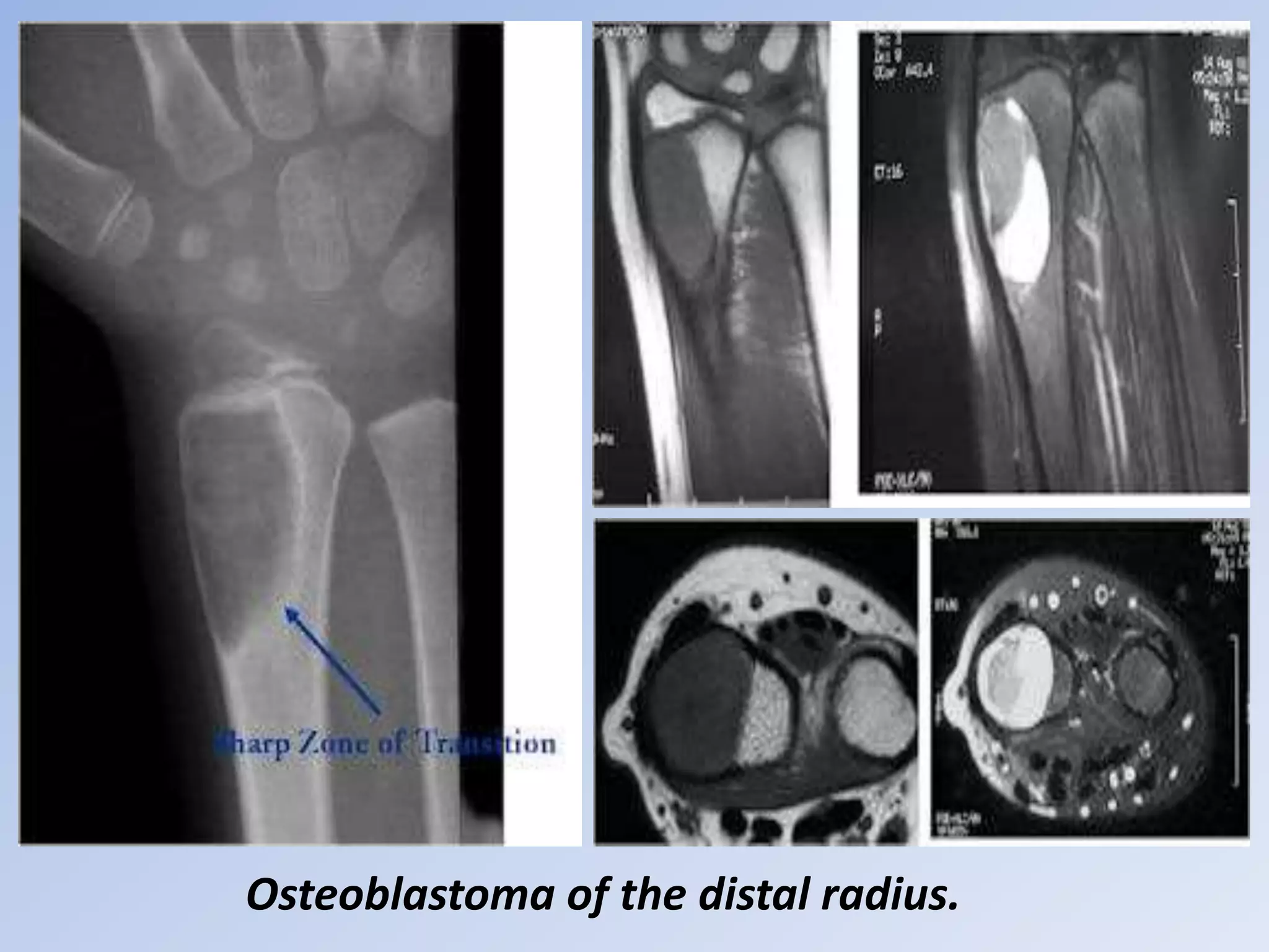 Presentation1.pptx, interpretation of x ray on bone tumour. | PPT Presentation1.pptx, interpretation of x ray on bone tumour. | PPT