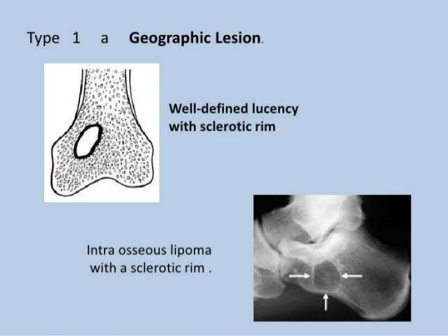Presentation1.pptx, interpretation of x ray on bone tumour. Presentation1.pptx, interpretation of x ray on bone tumour.