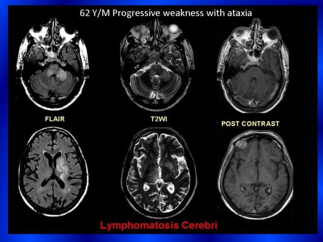 Presentation1.pptx, imaging modalities of intra cerebral lymphoma. | PPT