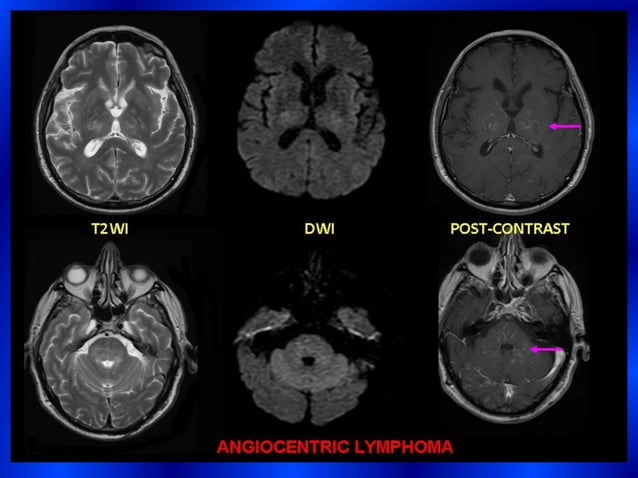 Presentation1.pptx, imaging modalities of intra cerebral lymphoma. | PPT