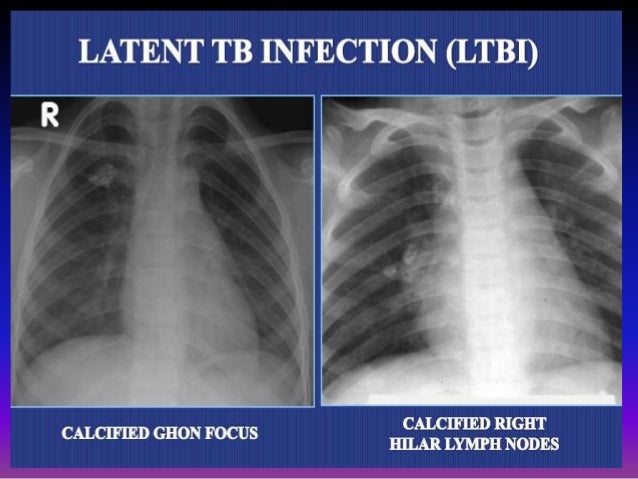 Presentation1.pptx, pediatric tb diseaase