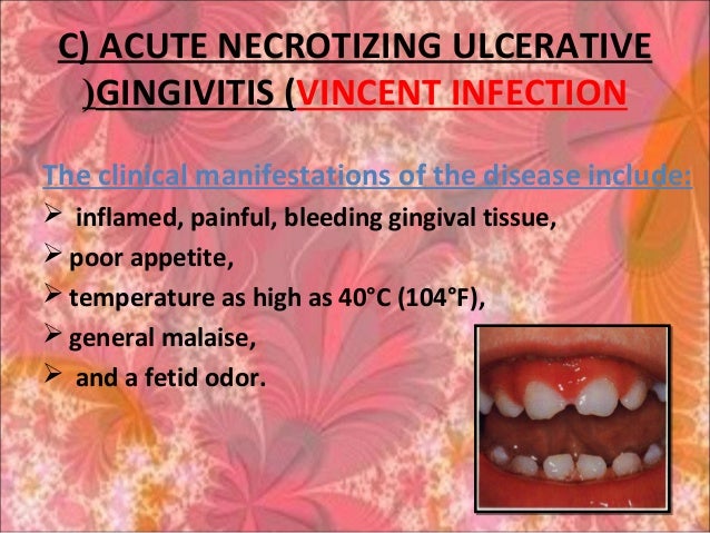 gingival diseases in children