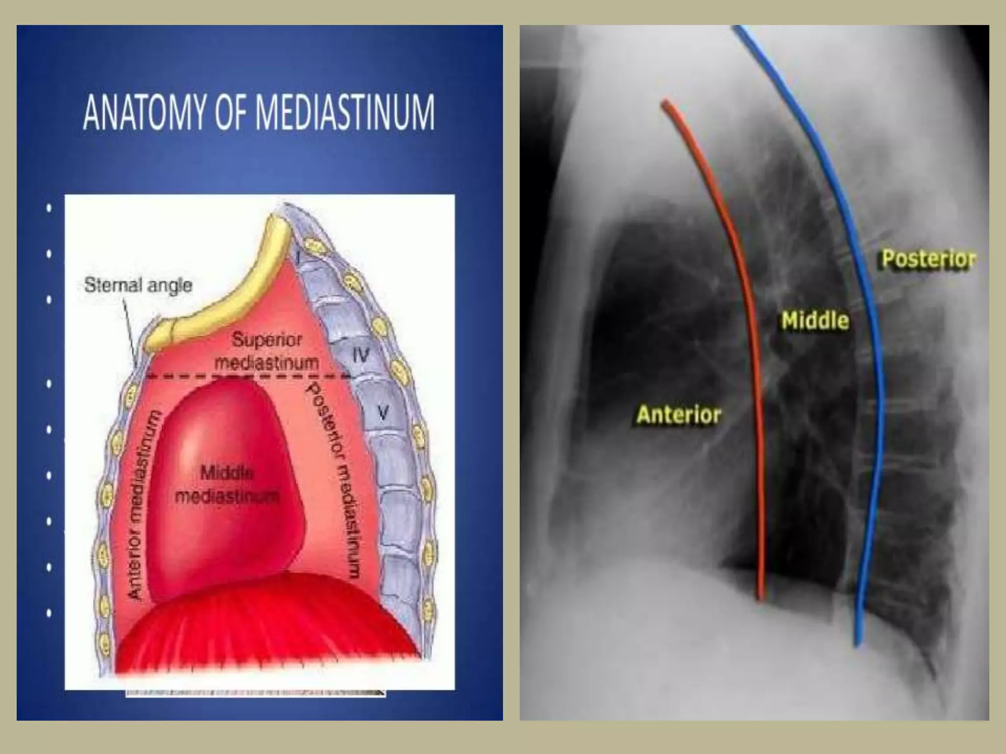 Presentation1.pptx radiological imaging of mediastinal masses . | PPTX