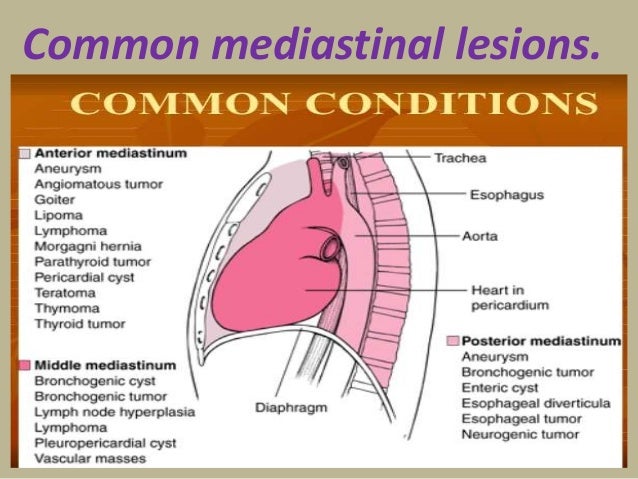 Presentation1.pptx radiological imaging of mediastinal masses