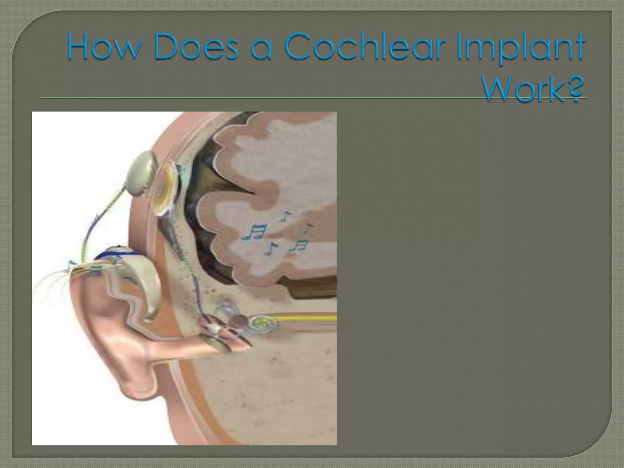 cochlear implant | PPTX