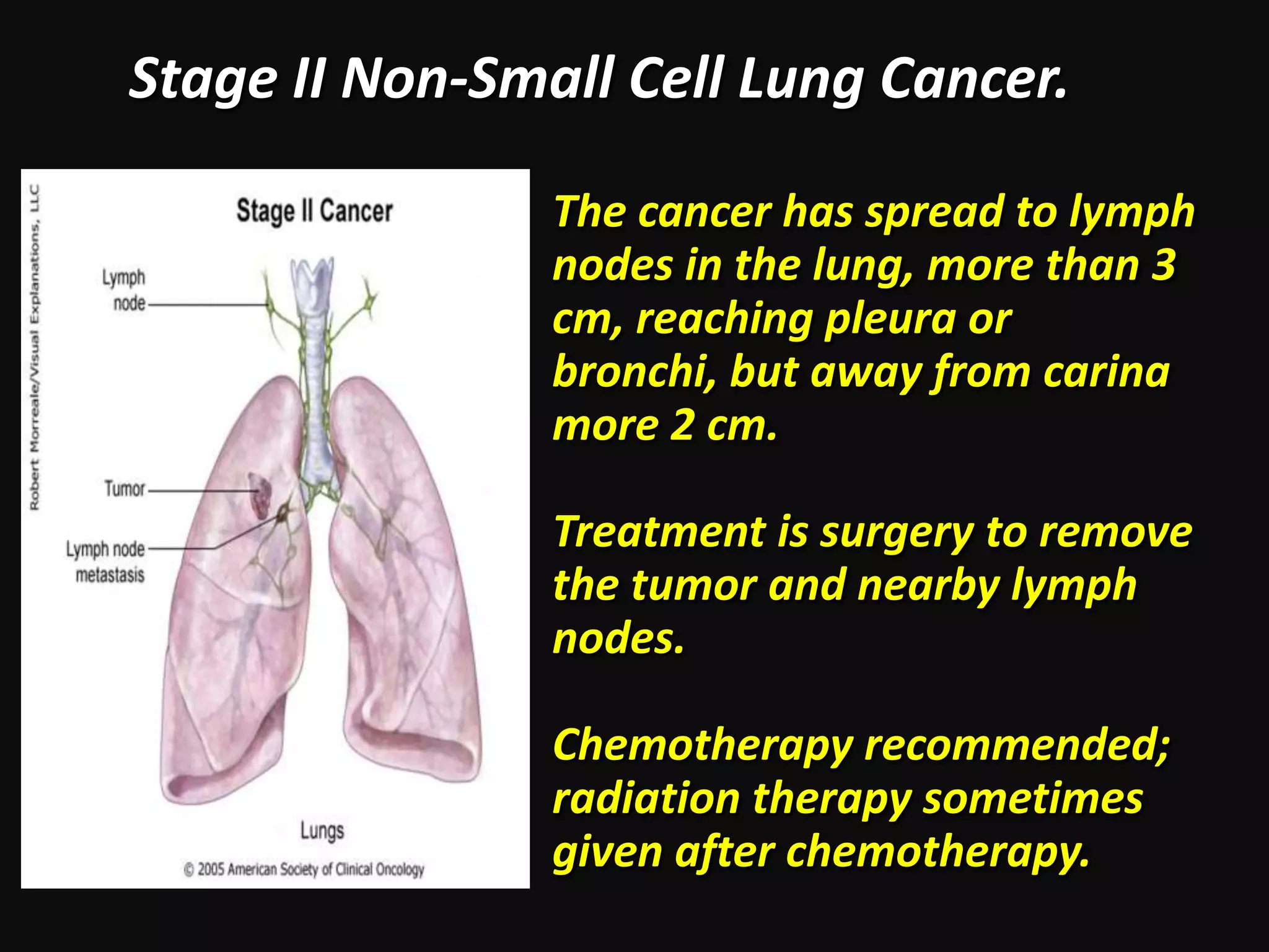 Presentation1.pptx. radiological imaging of bronchogenic carcinom. | PPTX